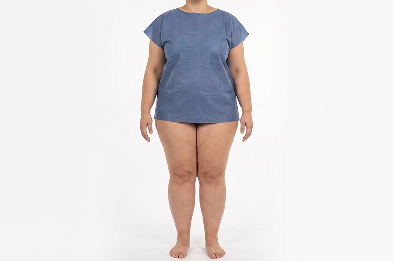 What Is Lipedema? Symptoms, Causes, Diagnosis and Care | Viva Magazine